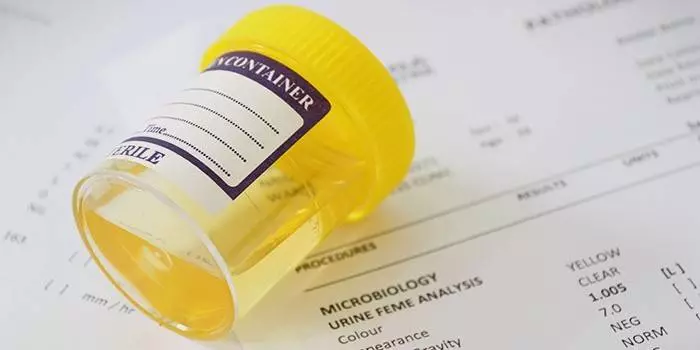 Urine analysis for pyelonephritis