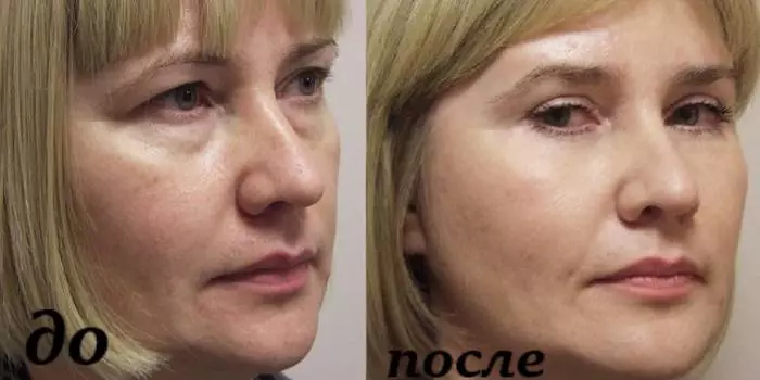 Obličej před a po mezoterapii