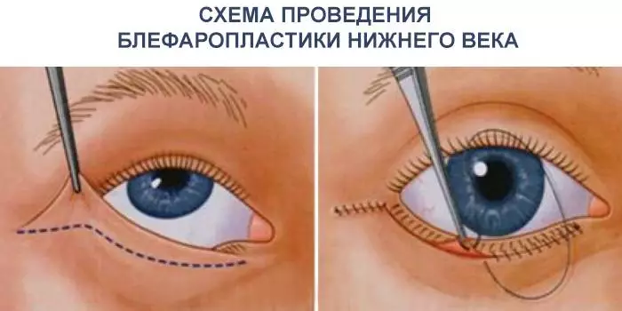 Schema för blefaroplastik i nedre ögonlocket