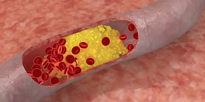 Didelio cholesterolio kiekio kraujyje simptomas