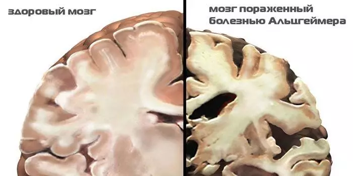 Муқоисаи мағзи солим ва майнае, ки гирифтори бемории Алтсгеймер аст