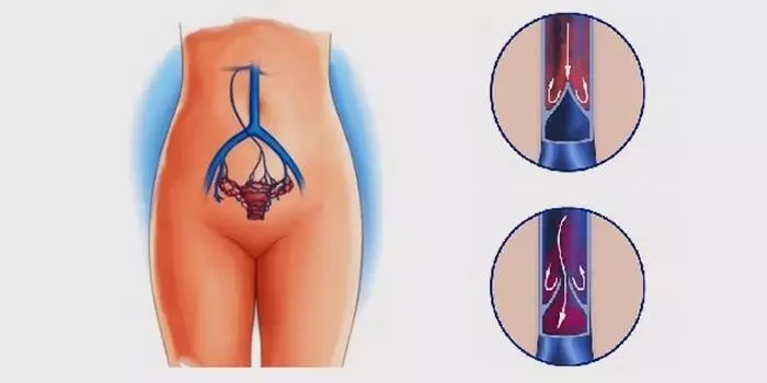 Form and degree of varicose veins of the small pelvis