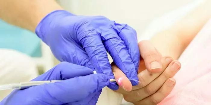Лекарот прави ласерско отстранување на папилома од кожата на прстот на пациентот