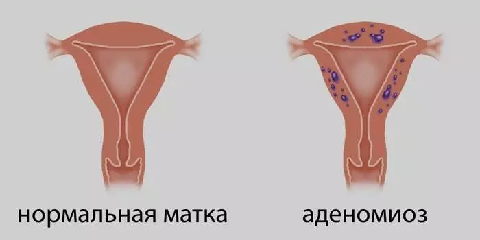 Normalna maternica i maternica s adenomiozom