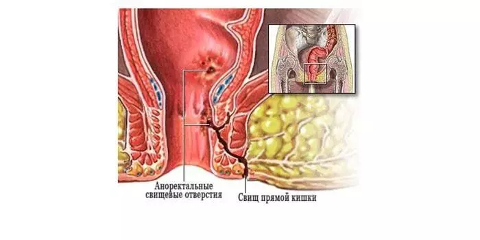 fistula រន្ធគូថ