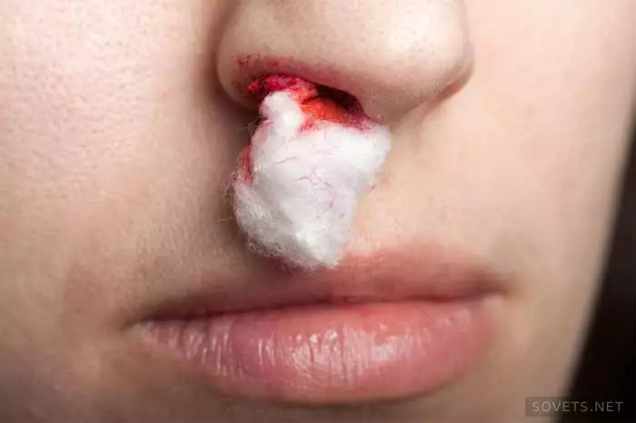 Si të ndaloni gjakderdhjen nga hunda - udhëzues hap pas hapi, metodat më efektive dhe të thjeshta