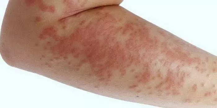 Allergischer Hautausschlag