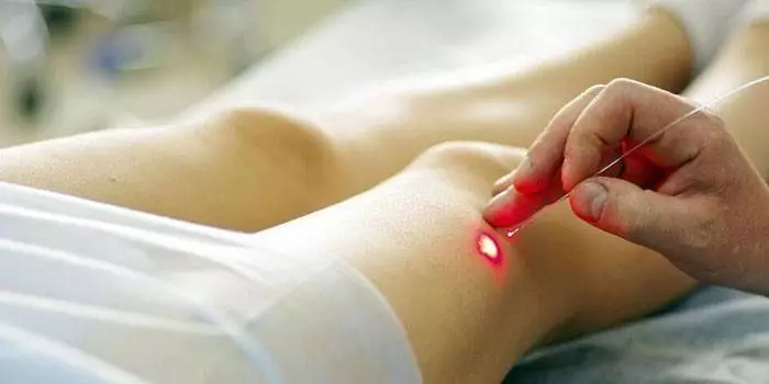 Pembuangan laser ateroma pada kaki pesakit