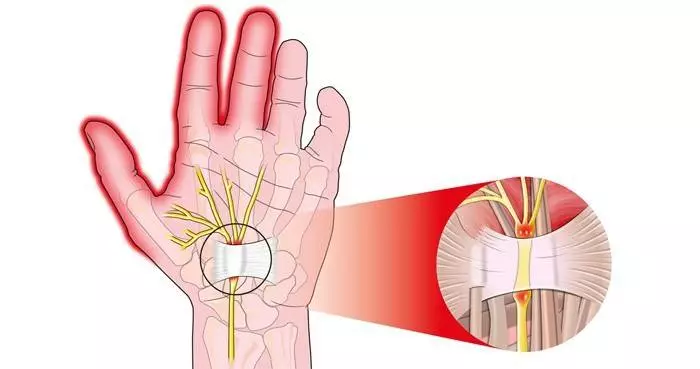 Các đầu dây thần kinh bị chèn ép trên cánh tay