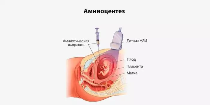 Amniocentesis sur la diagramo