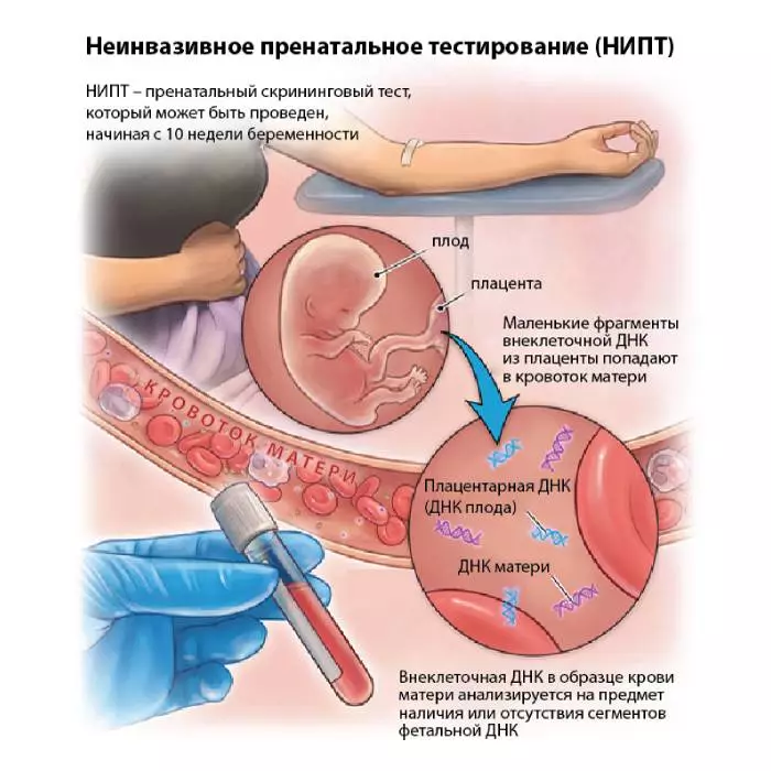 Ei-invasiivinen synnytystä edeltävä testaus (NIPT)