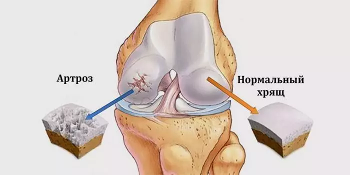 Проява на артроза на колянната става
