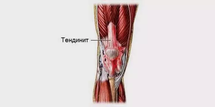 Localizarea tenditei în articulația genunchiului