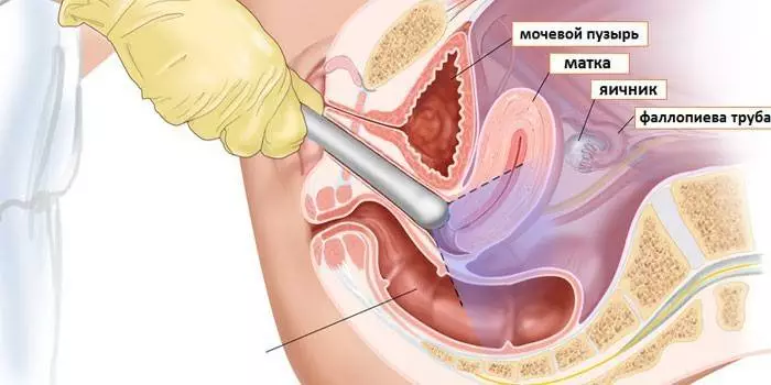 แบบแผนของการทำอัลตราซาวนด์ transvaginal