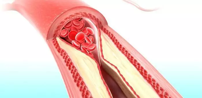 Nádoba s nahromaděným cholesterolem