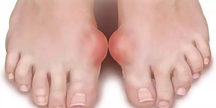 Gota nos pés