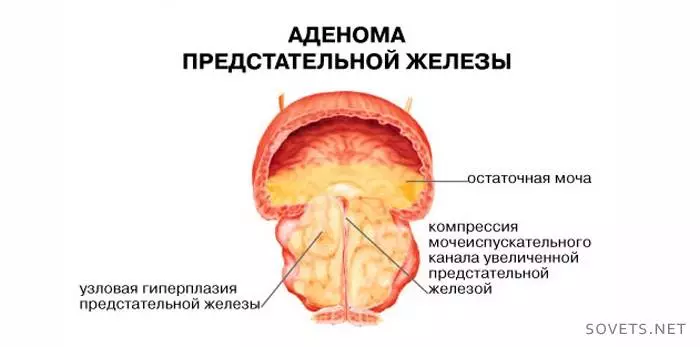 前列腺腺瘤