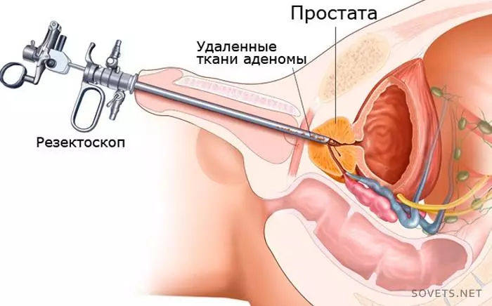 前列腺腺瘤的微創治療
