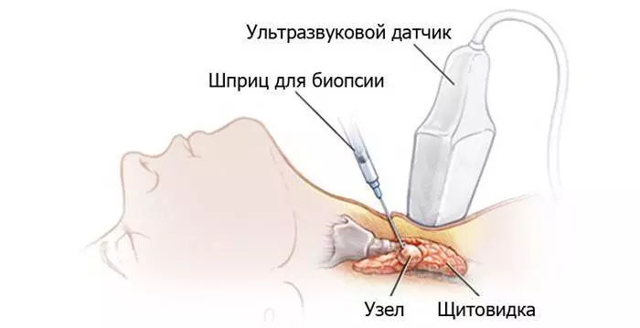 Kedu ka esi eme mkpọtụ nke gland thyroid?