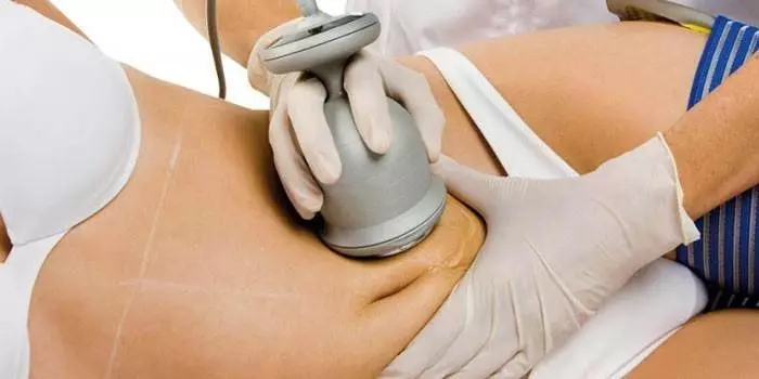 Meitenei tiek veikta ultraskaņas kavitācijas procedūra