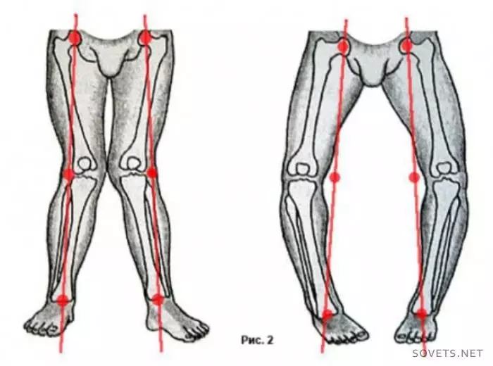 defekter i placeringen av ben med gonartos