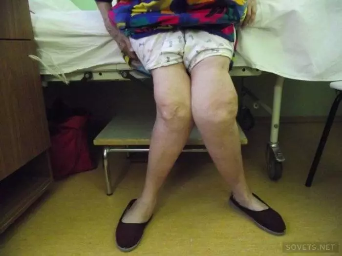 Лечение на артроза на колянната става с народни средства