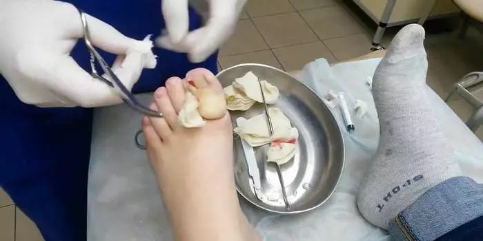 Hirurg uklanja nokte na nogama