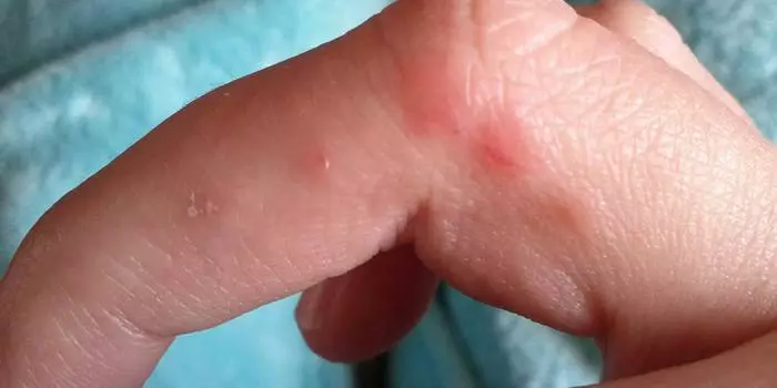 Leziuni pe pielea degetelor
