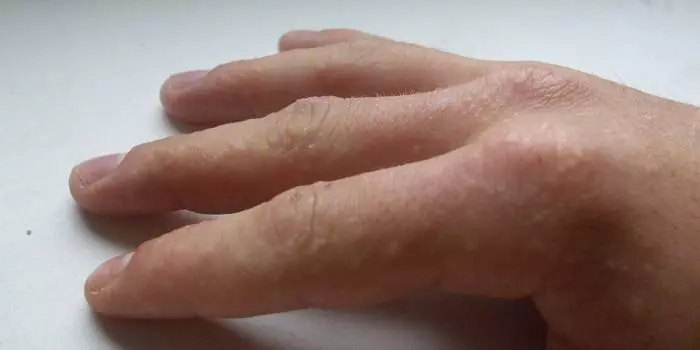 Boli de piele ale degetelor