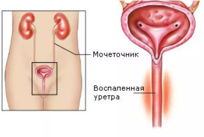 Urethra igbona