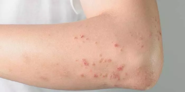 Orticaria allergica sulla pelle delle mani