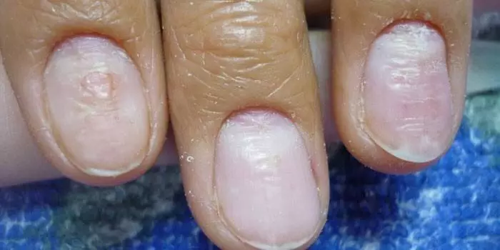 変形した指の爪