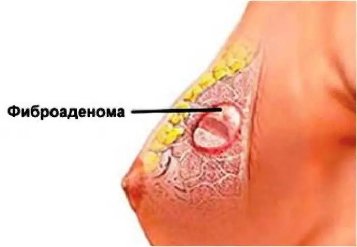 Tumor fibroadenoma