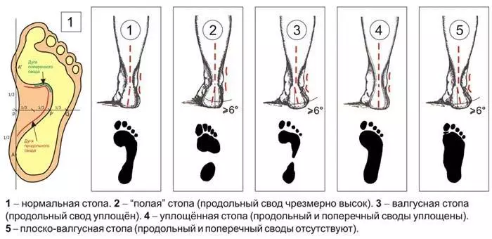 Ravna stopala u djece - kako odrediti opseg, simptome i liječenje