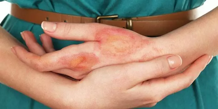 Dermatitis a la mà d’una dona