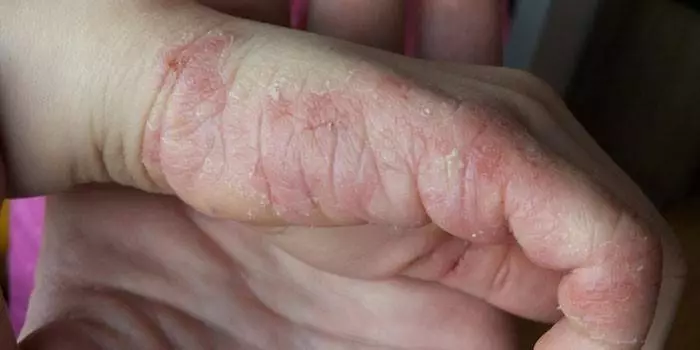 Dermatitis atopik ing telapak tangan