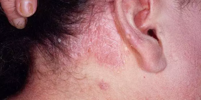 Dermatitis seborrheig ar groen y pen menyw