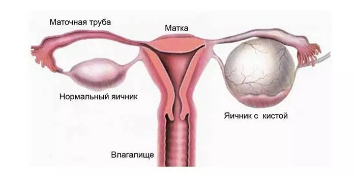 Ovarian cyst igishushanyo