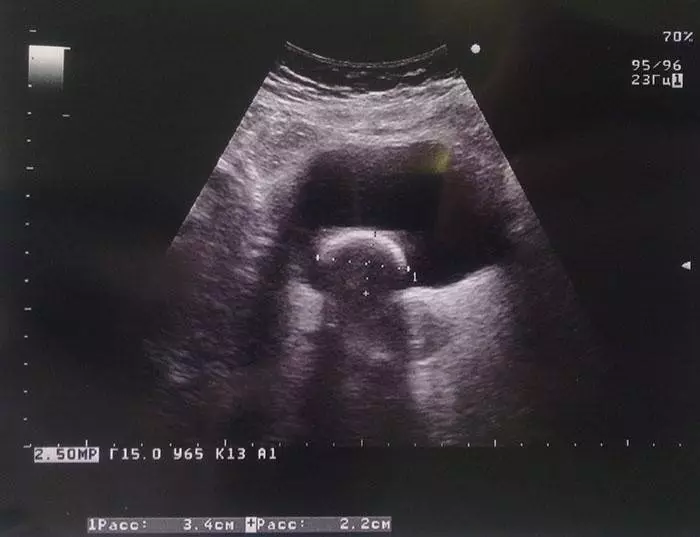 Sary ultrasound bubble