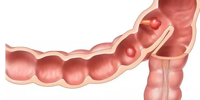 Intestinal wall polyps