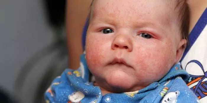 Dermatitis atópica en la cara del bebé.