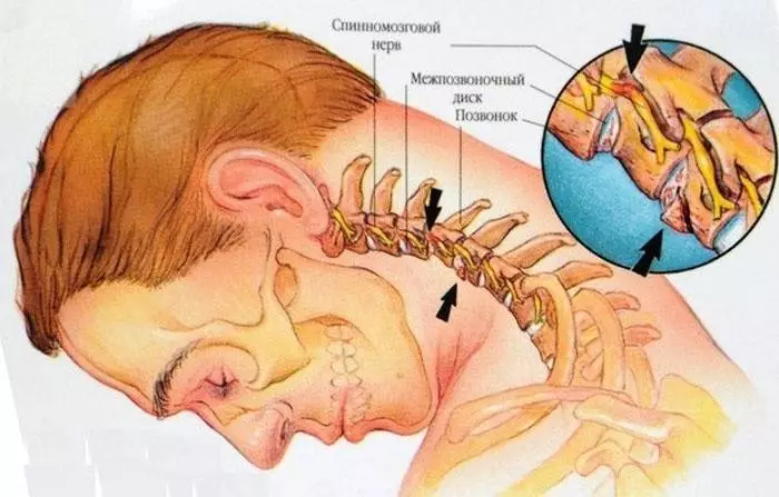 Вратът боли отзад, наляво, надясно: причини и методи на лечение при възрастни и деца (видео)