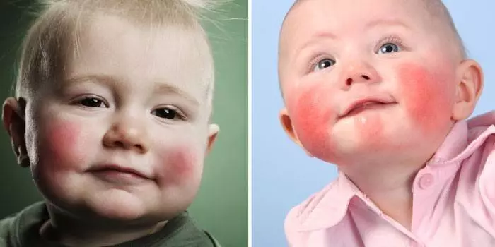 Manifestacije dječje dijateze na obrazima u beba