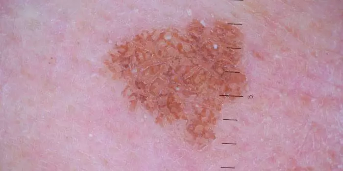 Follicular keratosis sa panit sa tawo