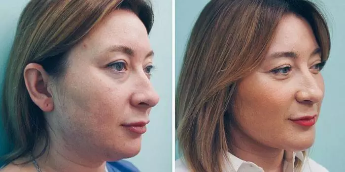 Mujer antes y después de las inyecciones lipolíticas.