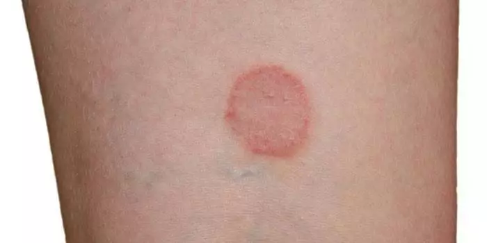 Pityriasis ત્વચા પર ગુલાબી