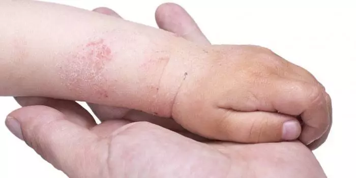 Eczéma dans la main d'un enfant