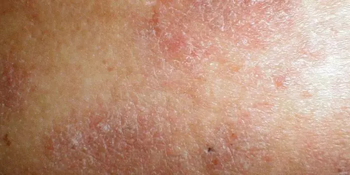 Dyshidrotic eczema na akpụkpọ ahụ