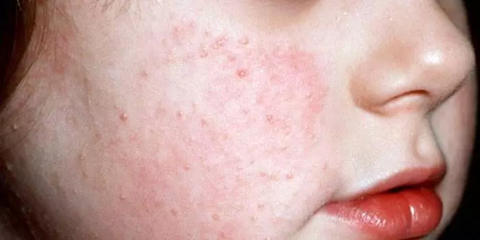 Keratosis folikel di pipi