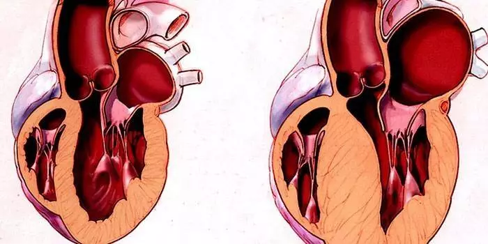 Hypertrophic cardiomyopathy - causes and signs, symptoms and treatment